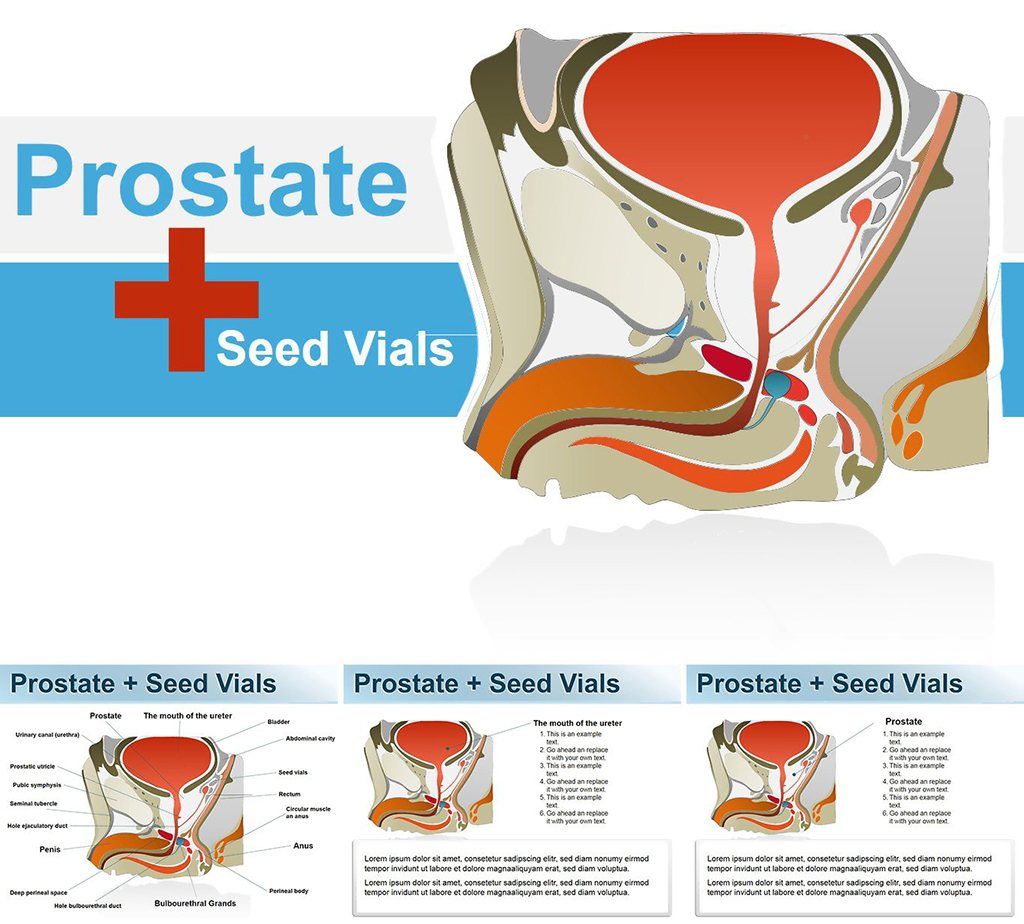 Prostate Keynote shapes